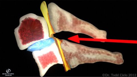 Spinal Ligament Laxity | What MRIs Miss & How Motion Reveals Instability